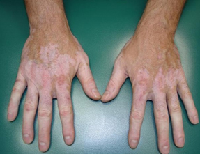 Chemical Leukoderma