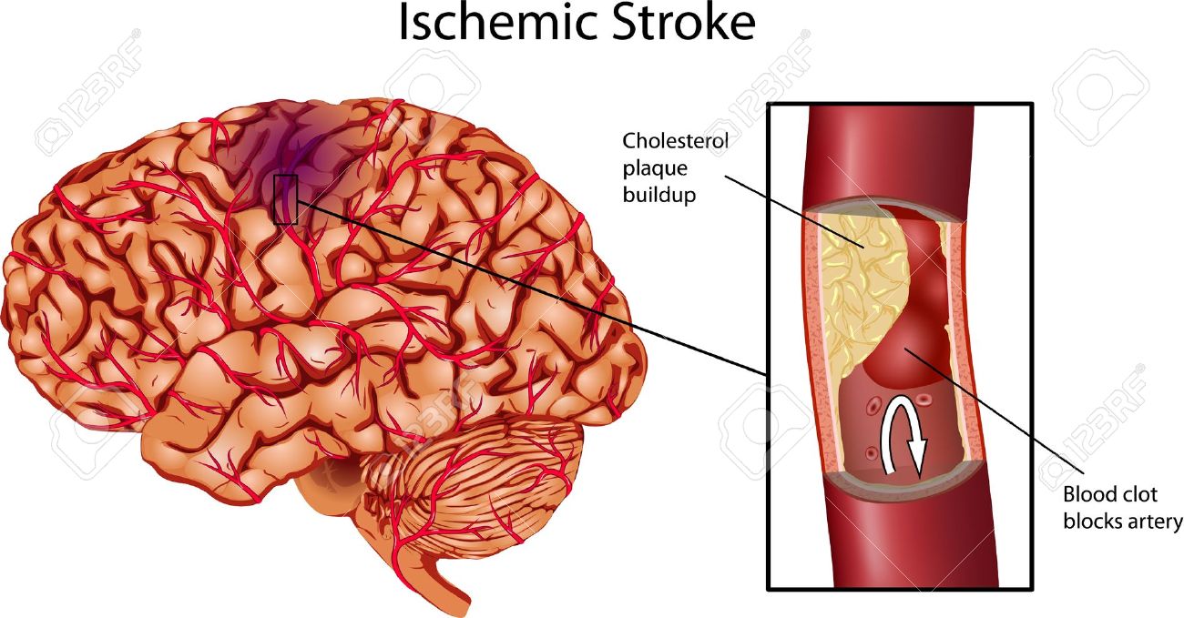 ISCHEMIC STROKE Is Caused By Blocked Artery I Sai Neuro Clinic