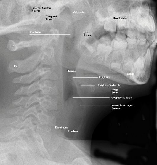 Aryepiglottic Fold Xray