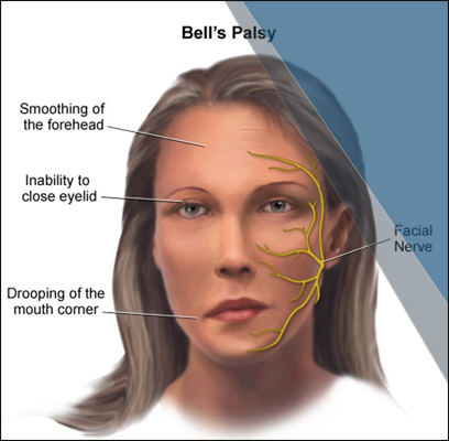 Bell's palsy is a weakness that effects the m | Beyond Infinity ...