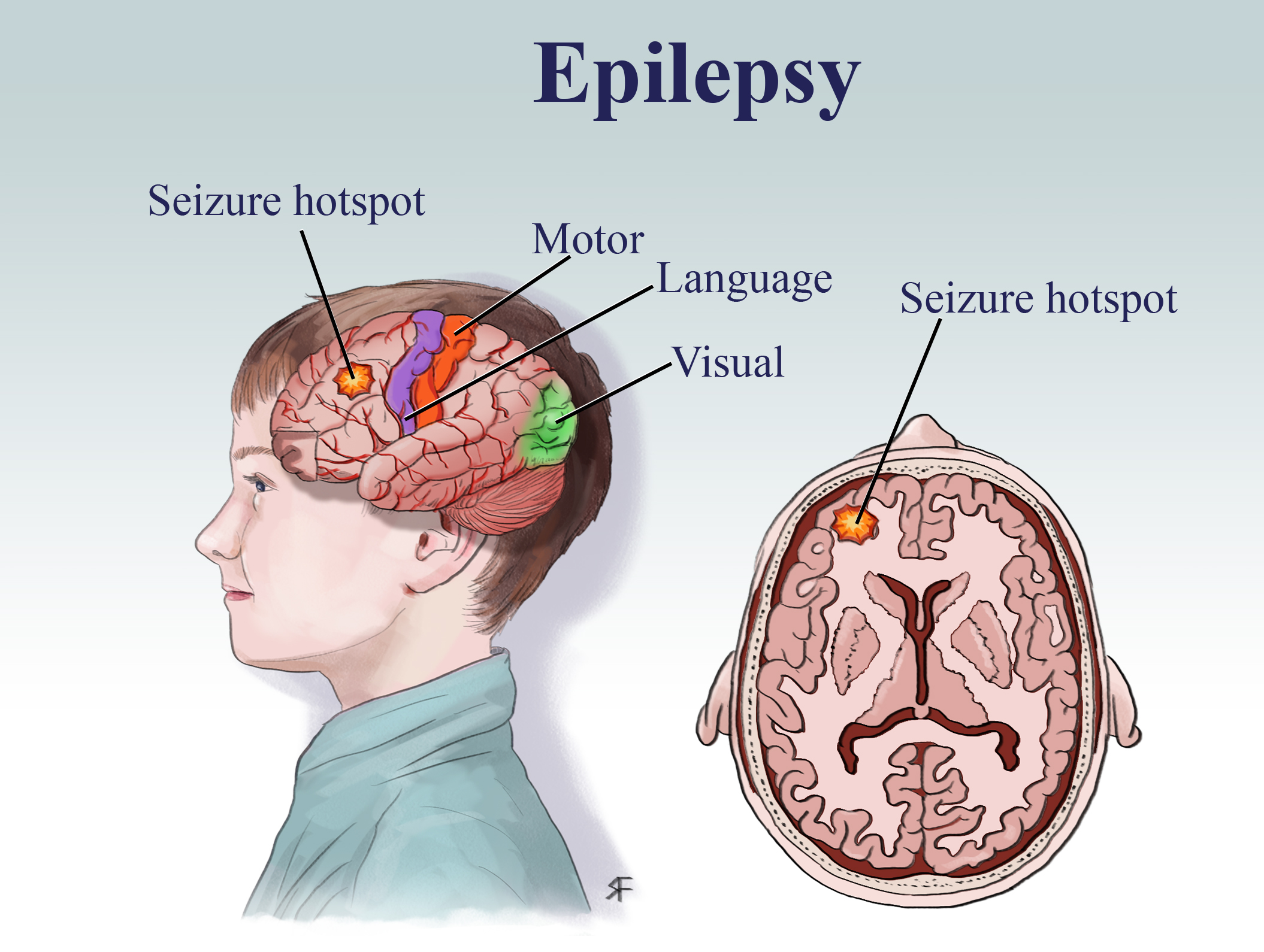 EPILEPSY What Are Seizures And Epilepsy Epilepsy Is A Medical 