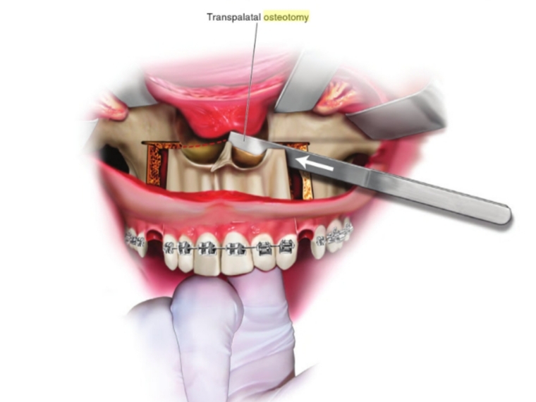 Anterior Maxillary osteotomy is a type of orthognathic surgery used to ...