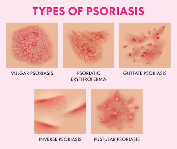 Best Ayurvedic Treatment of Psoriasis in the city. Psoriasis की उत्तम ...