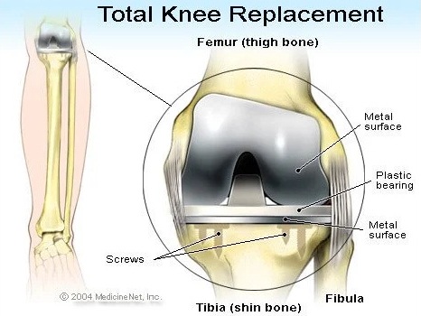 Hinge Joint Knee