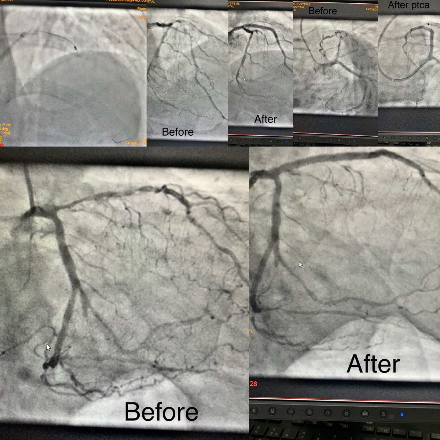 Rotational Atherectomy is a procedure used to breakup calcium deposited ...