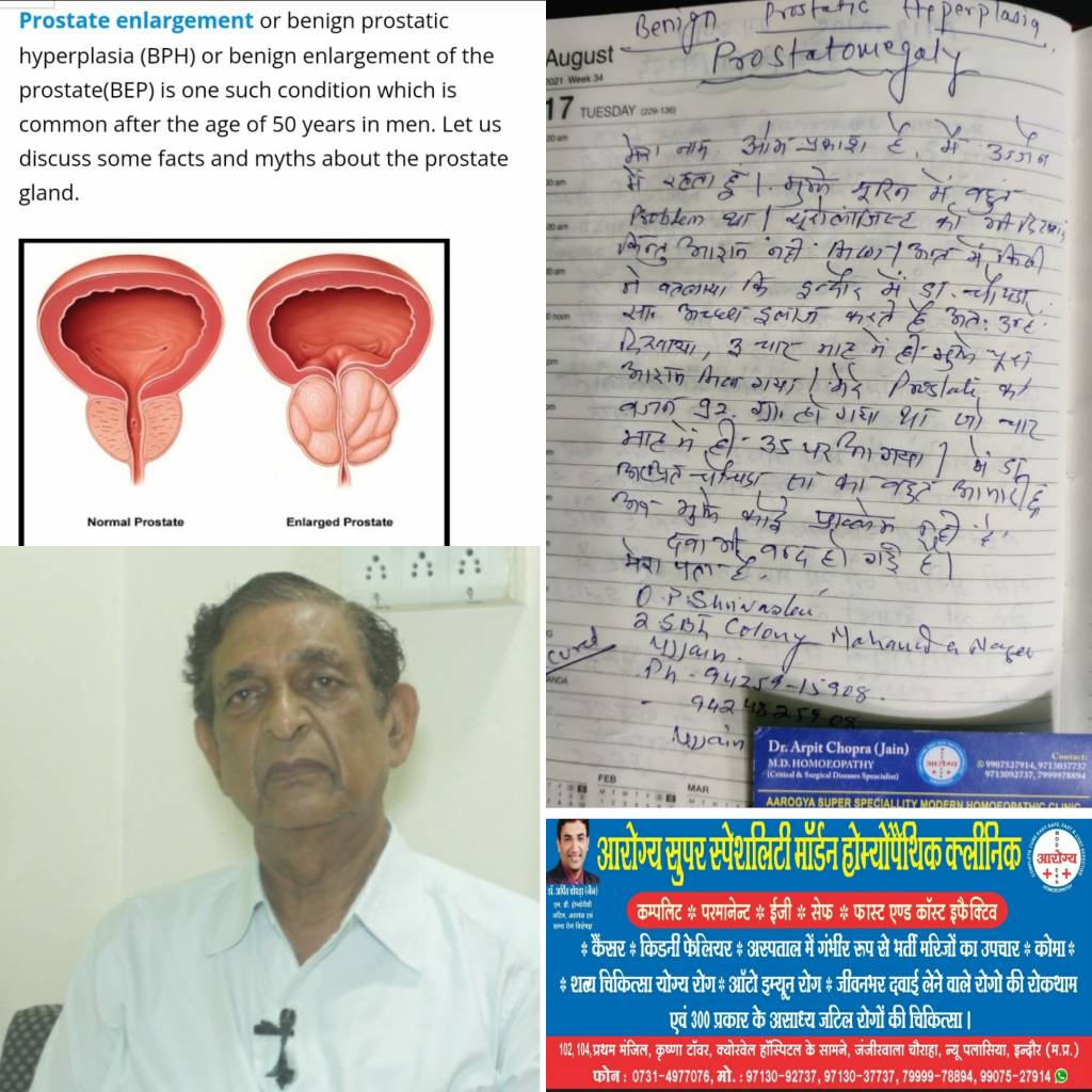 PROSTATOMEGALY BPH 90 GM WITH RAISED PVR CURED WITHOUT SURGERY