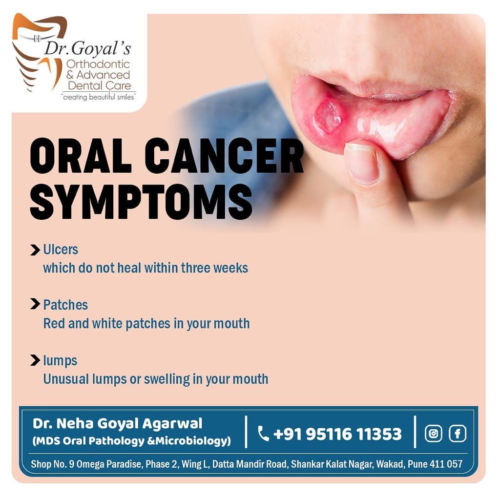 Symptoms Of Mouth Cancer Pictures - Infoupdate.org Symptoms Of Mouth Cancer Pictures - Infoupdate.org