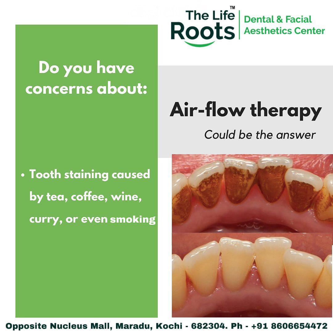 How Much Does It Cost to Clean Teeth in Kochi T The Life Roots Dental and Facial Aesthetic Center Ernakulam