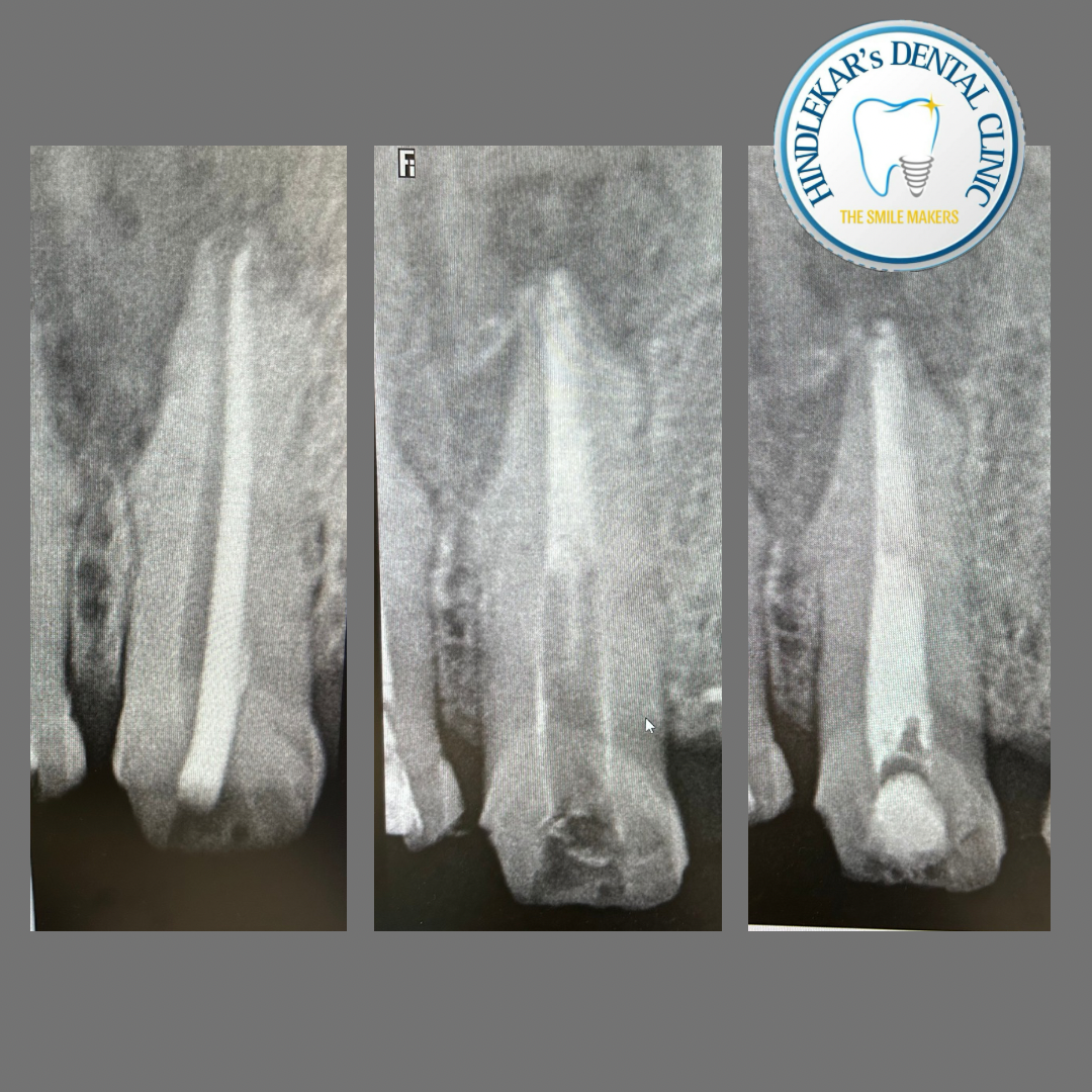 Management of failed root canal cases | DR AJIT HINDLEKARs DENTAL ...