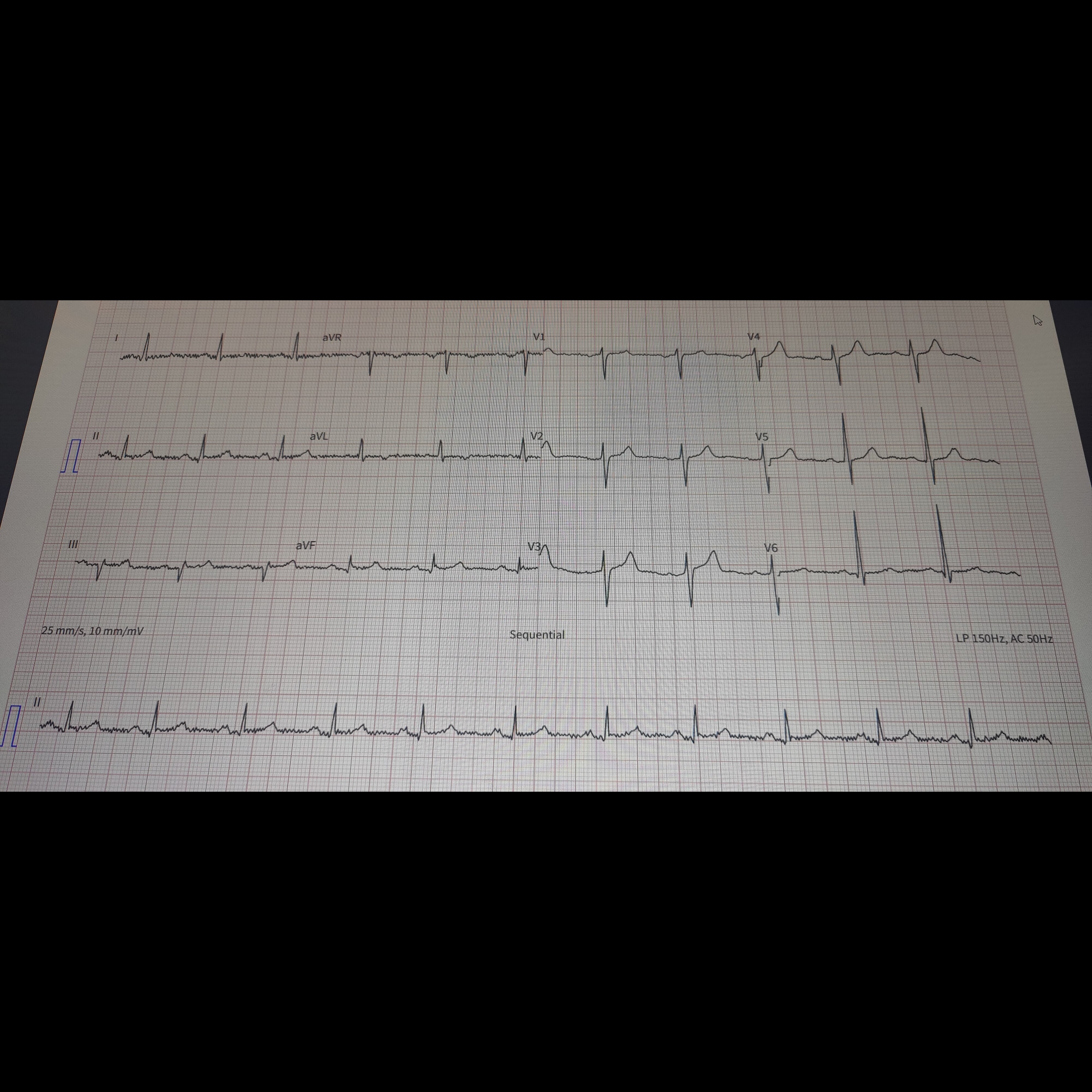 Atrial Flutter | Cure Clinic – Cardiology Clinic in Erandwane - Pune