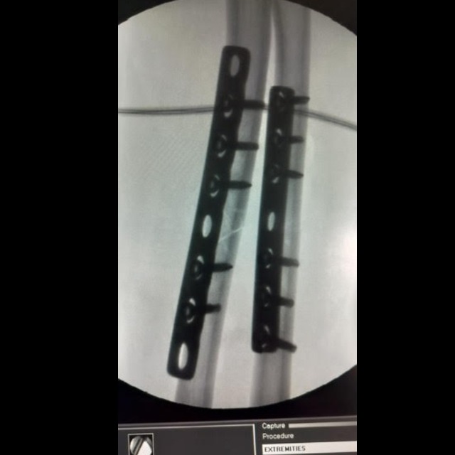 Fracture both bone forearm following bike accident | Dr. Pankaj Kumar ...